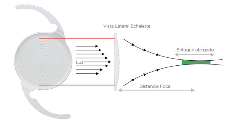 LIO TECNIS® Symfony ZXR – Extended Depth of Focus – Correción de ...
